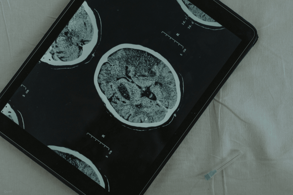 CBD vs THC for Brain Tumor: Research, Differences & Medical Insights