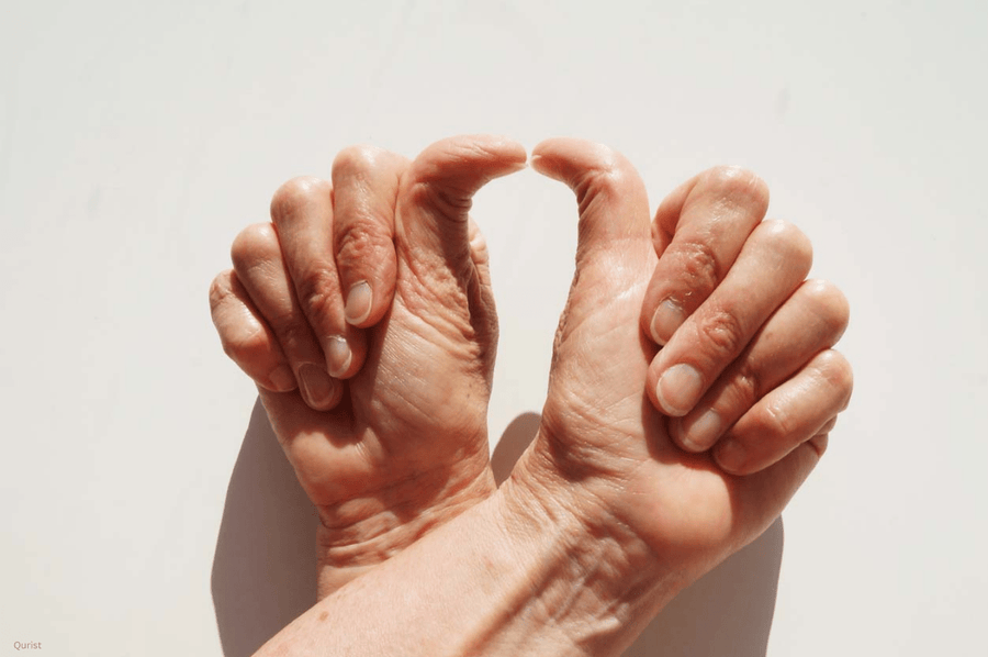 Ehlers-Danlos Syndrome: Symptoms, Types, and Management Guide 2025