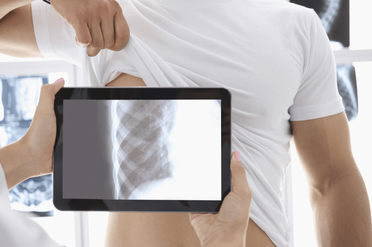 How Can CBD Oil Help in Case of Costochondritis? Explore